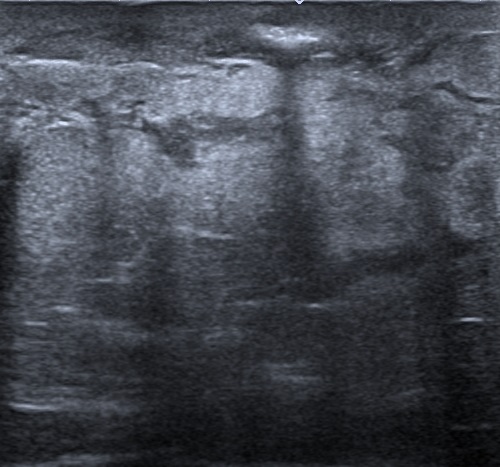 breast abscess after suction – Gynaecologia