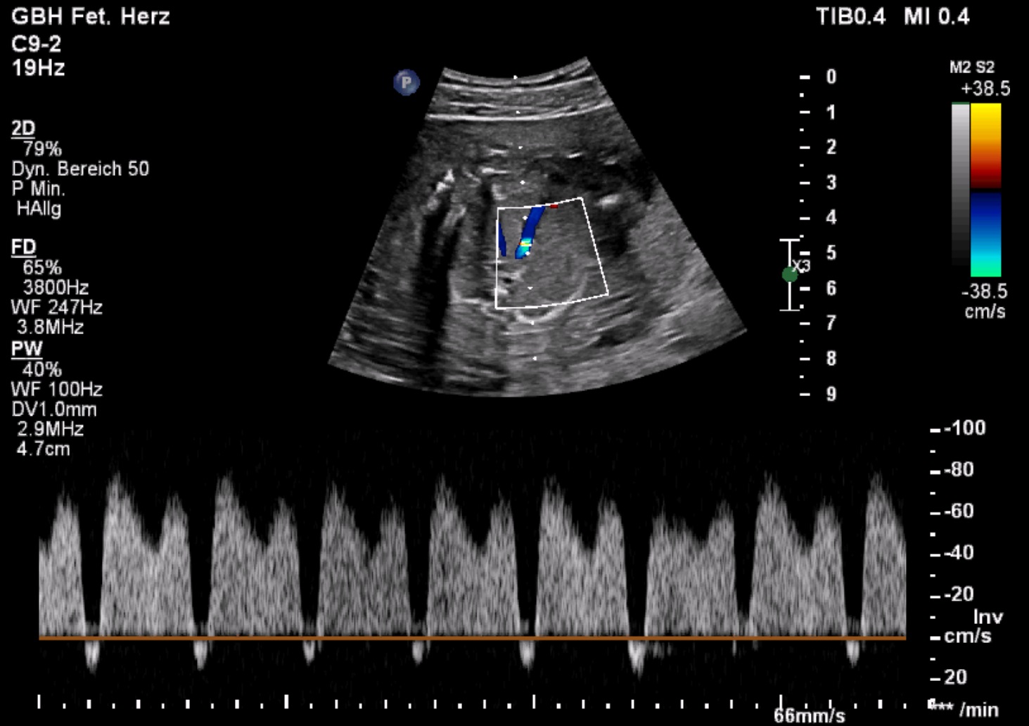 Double outlet right ventricle – Gynaecologia