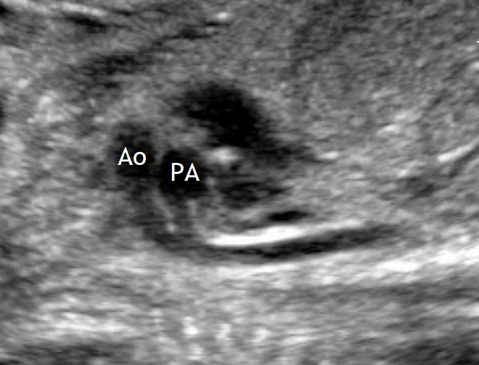 Complete transposition of the great arteries (d-TGA) – Gynaecologia