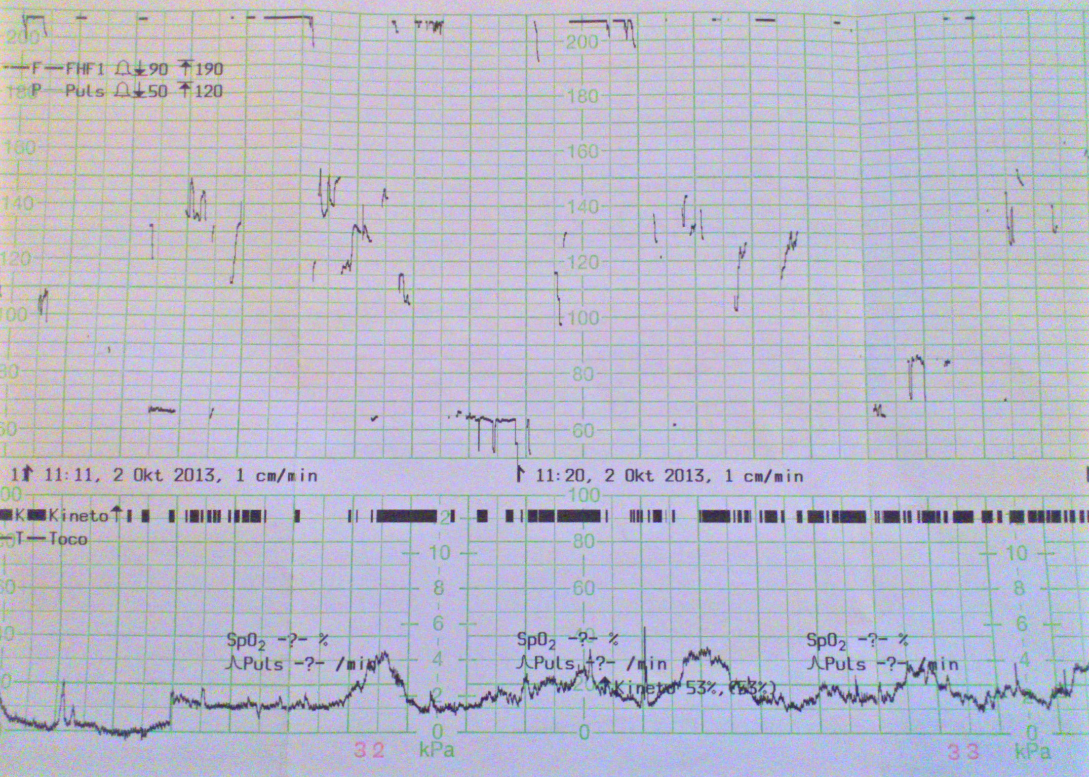 Fetal premature atrial contractions – Gynaecologia