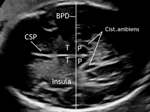 How to measure the BPD – Gynaecologia