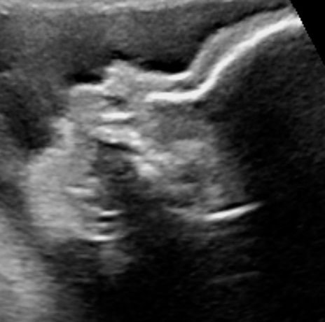 Absent nasal bone – Gynaecologia