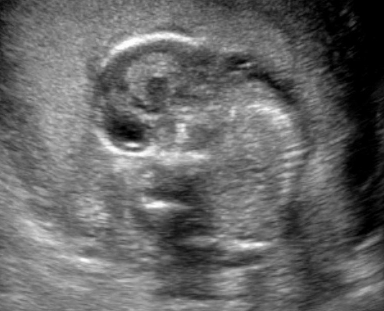 How to measure the amniotic fluid – Gynaecologia