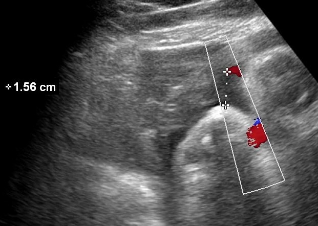 How to measure the amniotic fluid – Gynaecologia