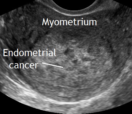 Endometrial Cancer – Gynaecologia