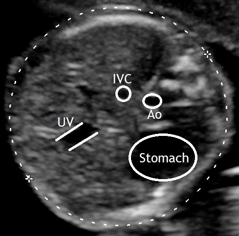 How to measure the abdominal circumference – Gynaecologia