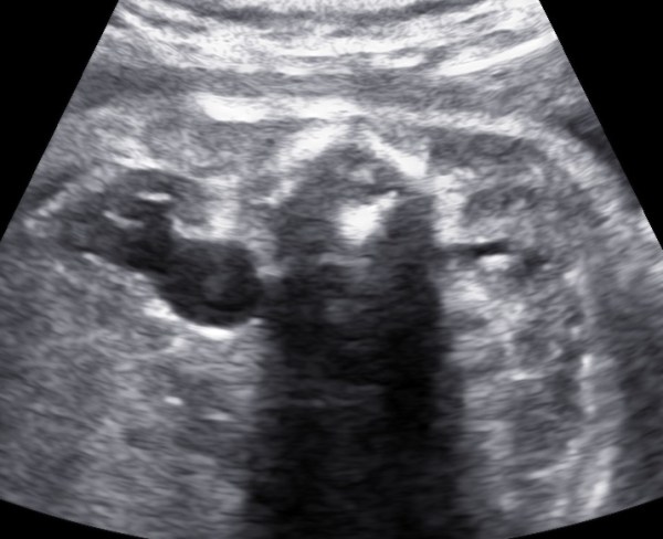 Fetal Hydronephrosis – Gynaecologia
