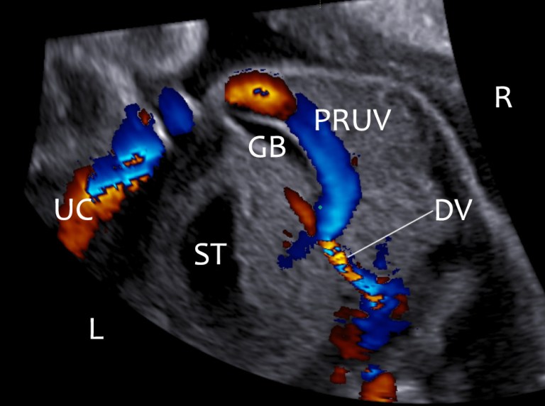 Persistent Right Umbilical Vein – Gynaecologia