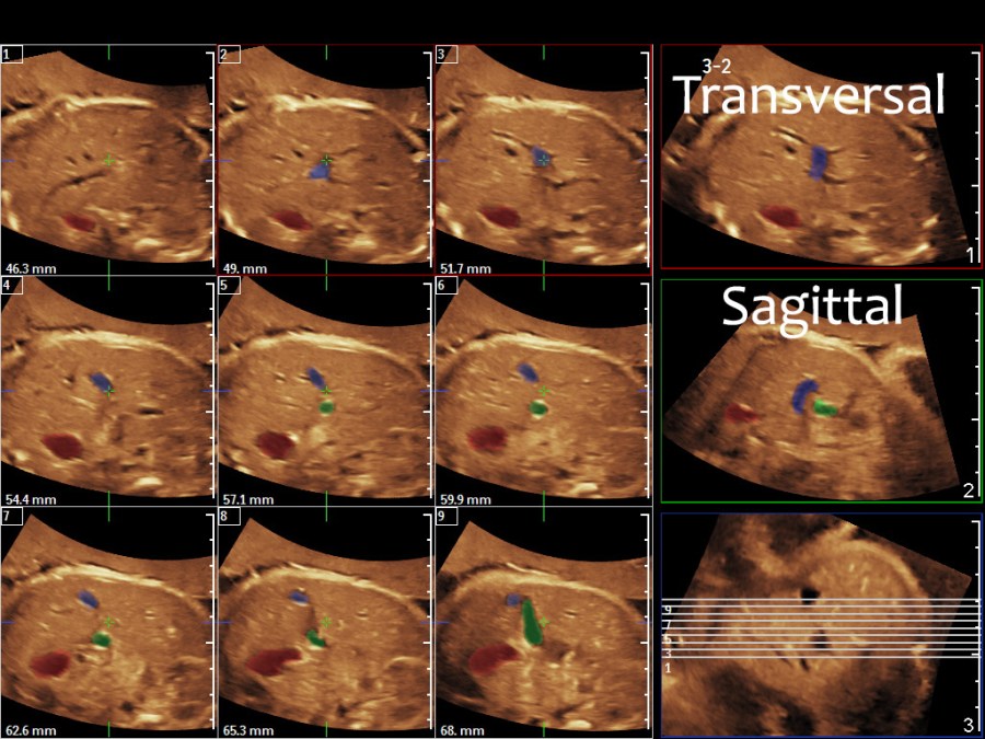 Persistent Right Umbilical Vein – Gynaecologia