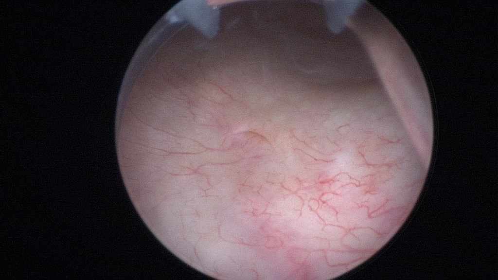 Transurethral Injection of Intramural Bulking Agent – Gynaecologia