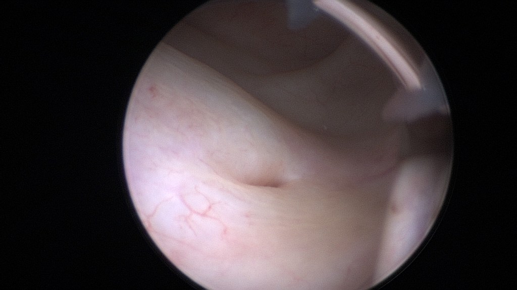 Transurethral Injection of Intramural Bulking Agent – Gynaecologia