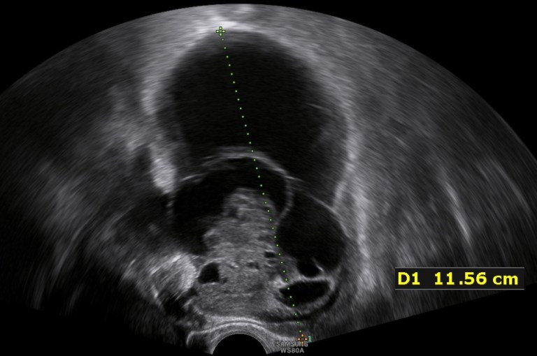 Laparoscopic Management of an Immature Teratoma – Gynaecologia