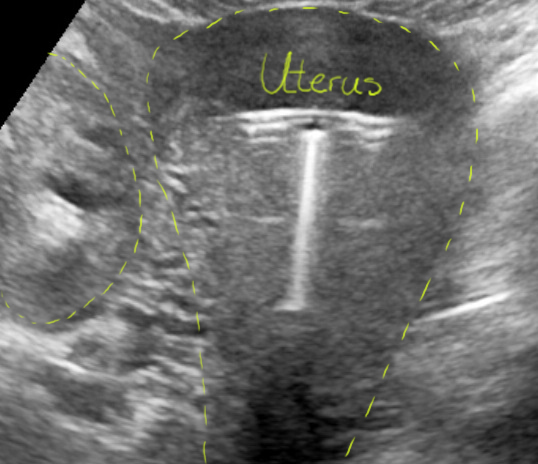 Masterclass – Ultrasound Study of the Tubal Ectopic Pregnancy ...