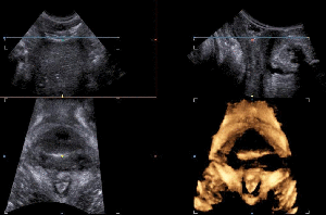 Levator Ani Avulsion – Gynaecologia