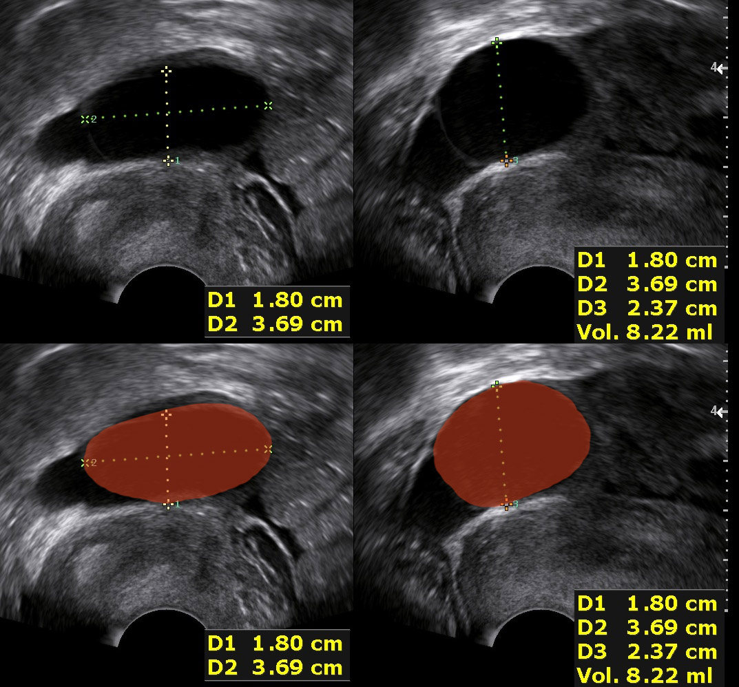 Paraovarian / Paratubal Cyst – Gynaecologia