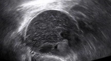 Struma ovarii – Gynaecologia