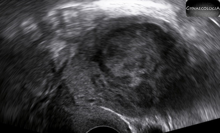 Smooth Muscle Tumor of Uncertain Malignant Potential (STUMP) – Gynaecologia